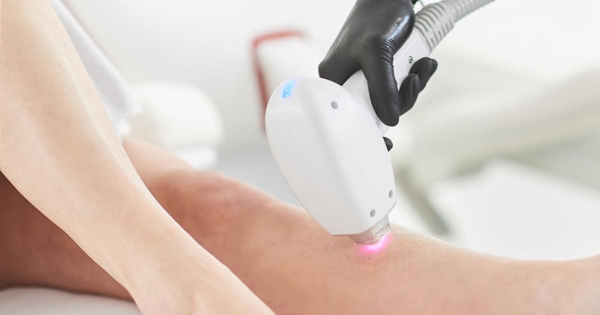 Épilation Définitive au laser diode - réservations près de chez vous - Celestetic Belgium